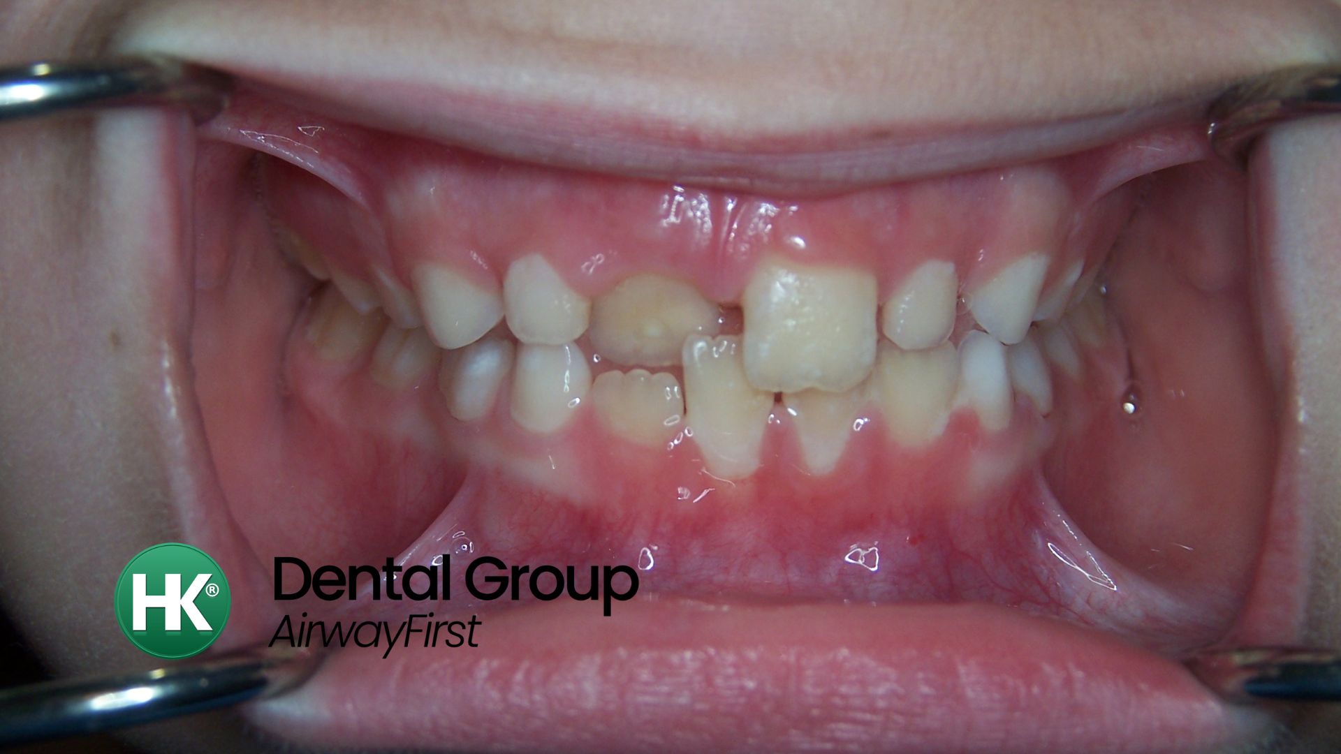 How To Fix One Front Tooth Behind The Other Without Braces – AirwayFirst™