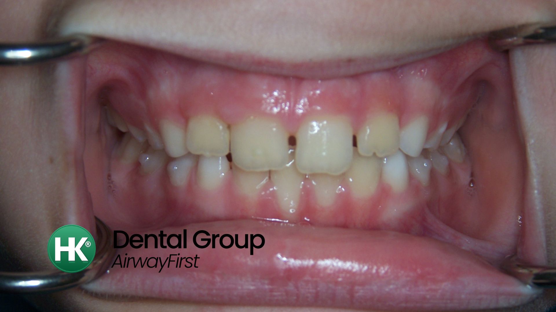 How To Fix One Front Tooth Behind The Other Without Braces – AirwayFirst®